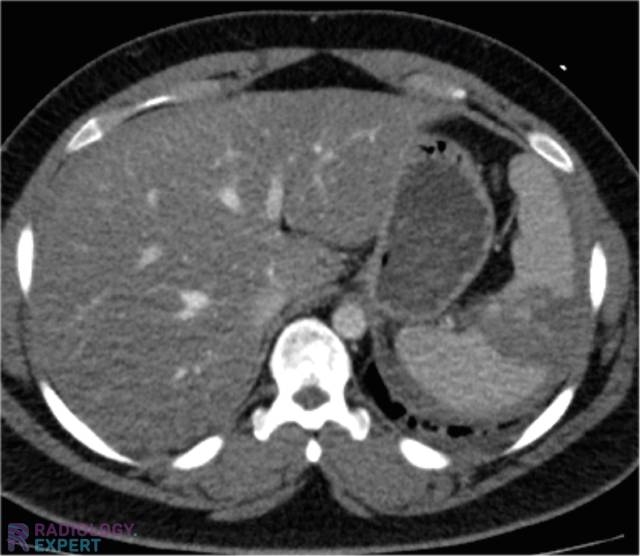 CT abdomen general